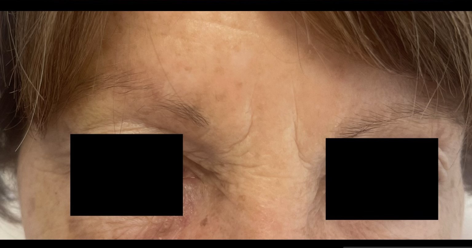 Botox Cashiers | Dr. Anita Medical Aesthetics